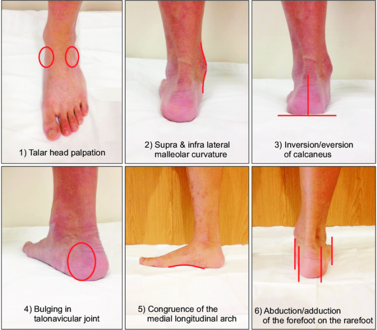 Problems with flat feet? This exercise might help